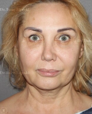 Before & After Deep Plane Facelift | Results Gallery - Tunç Tiryaki